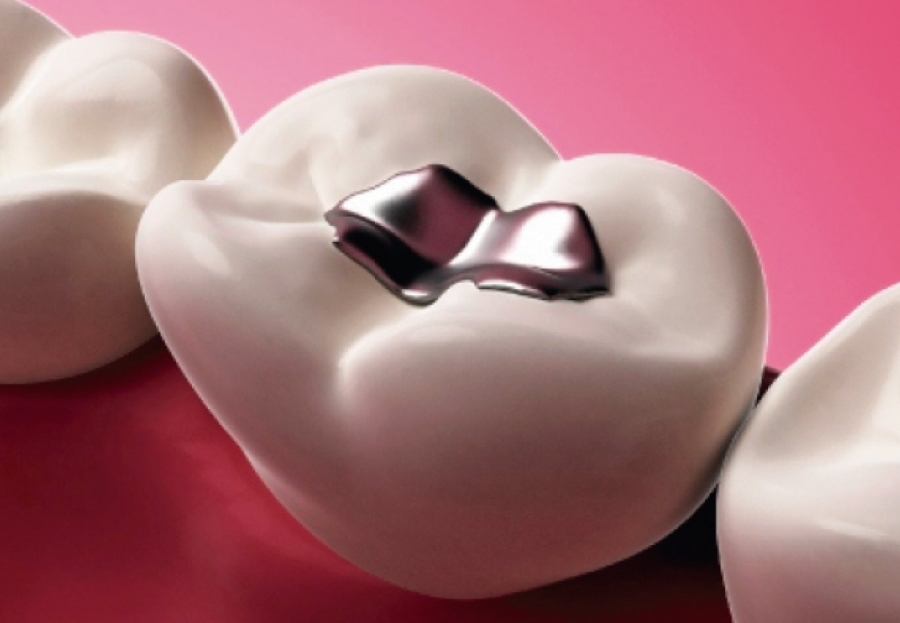 Amalgama dental y control del mercurio | Ministerio de Ambiente
